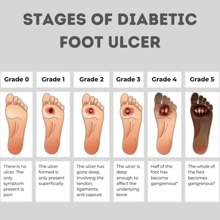 Diabetic Foot Ulcer Stages | Causes, Symptoms & Treatment
